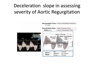 Echocardiographic evaluation of aortic regurgitation | PPT