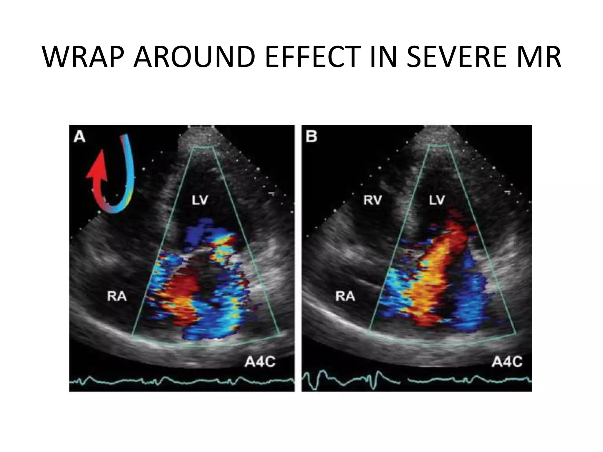 Echocardiographic evaluation of mitral regurgitation | PPTX