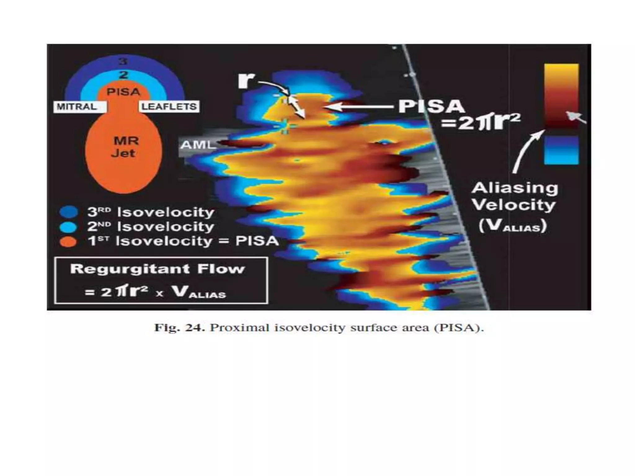 Echocardiographic evaluation of mitral regurgitation | PPTX
