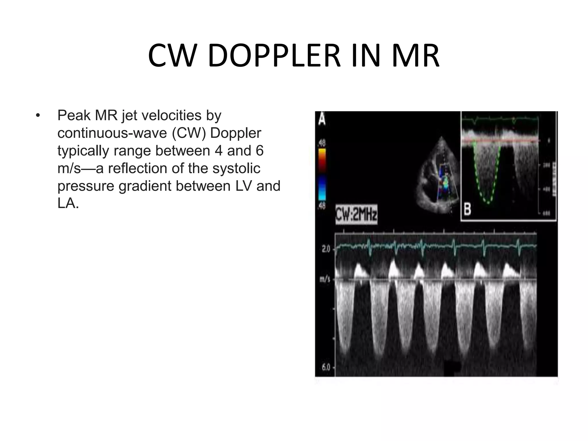 Echocardiographic evaluation of mitral regurgitation | PPTX