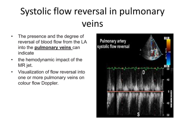 Echocardiographic evaluation of mitral regurgitation | PPTX | Heart and ...