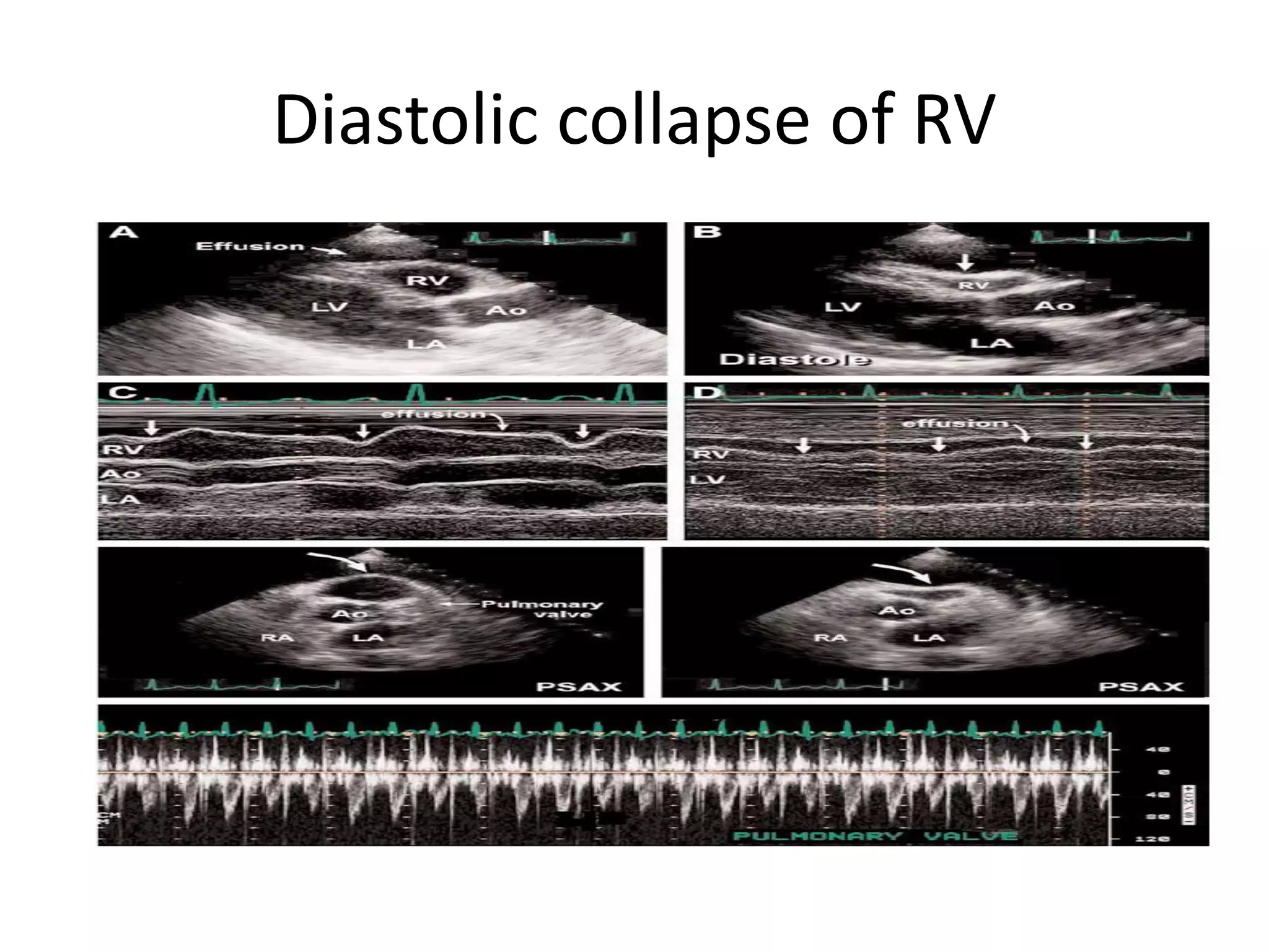 Echocardiographic evaluation of pericardium | PDF