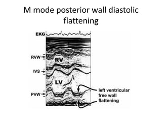 Echocardiographic evaluation of pericardium | PDF