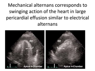 Echocardiographic evaluation of pericardium | PDF