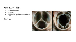 Echocardiographic evaluation of valvular stenosis.pptx