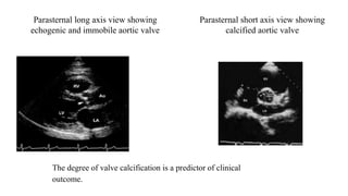 Echocardiographic evaluation of valvular stenosis.pptx
