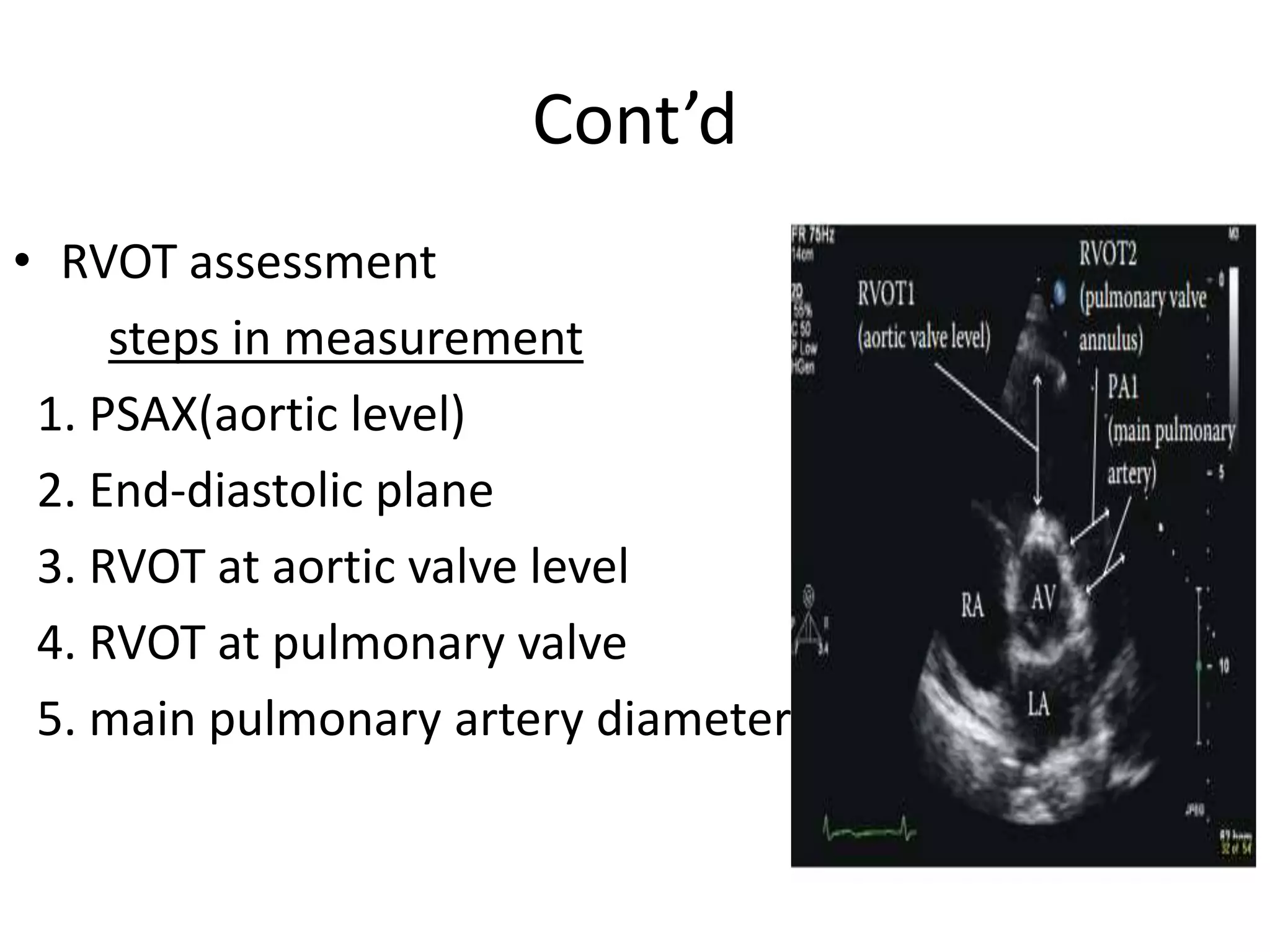 Echocardiographic measurements | PPTX
