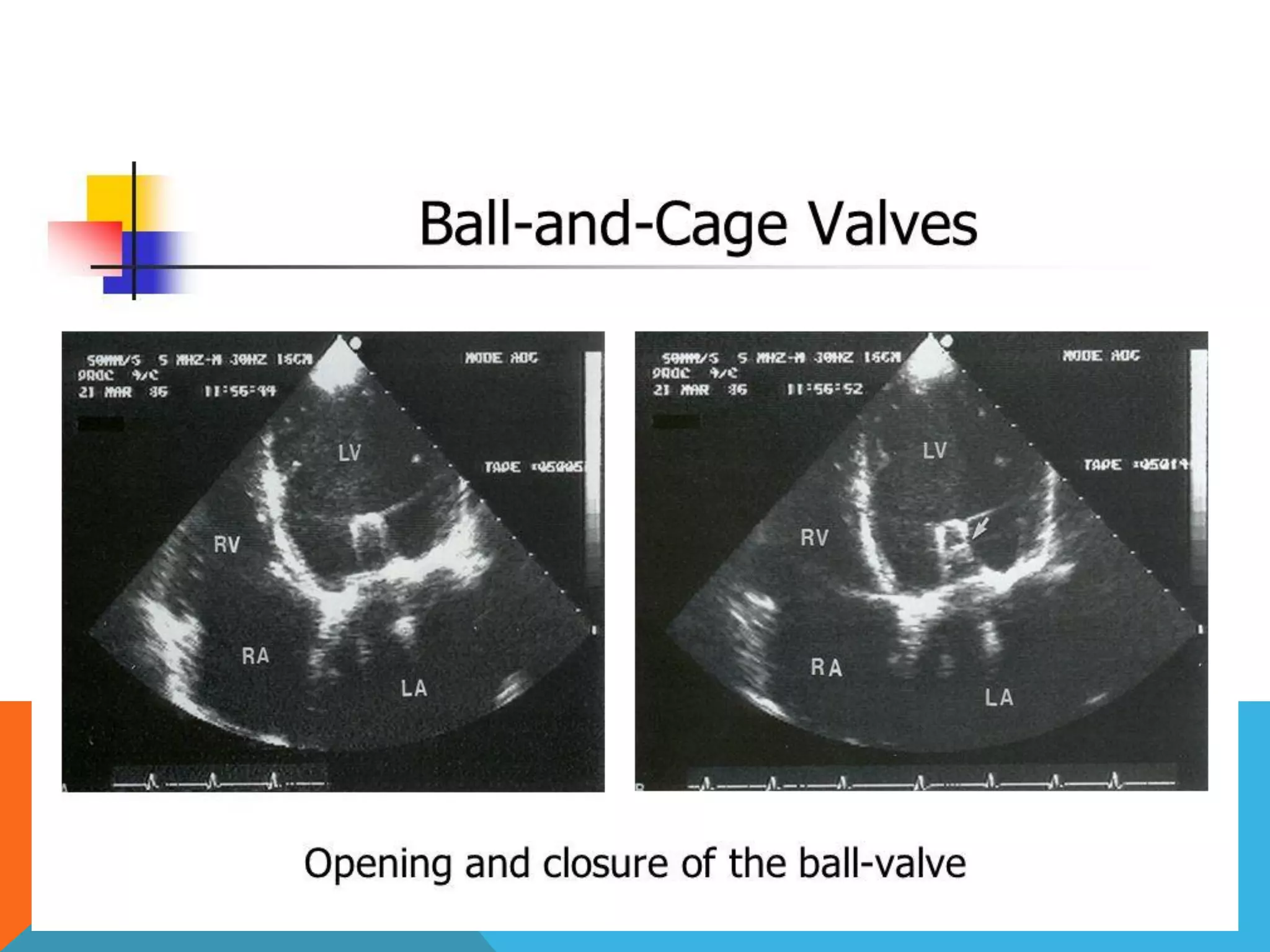 Echocardiographic recognition, function and dysfunction of prosthetic ...