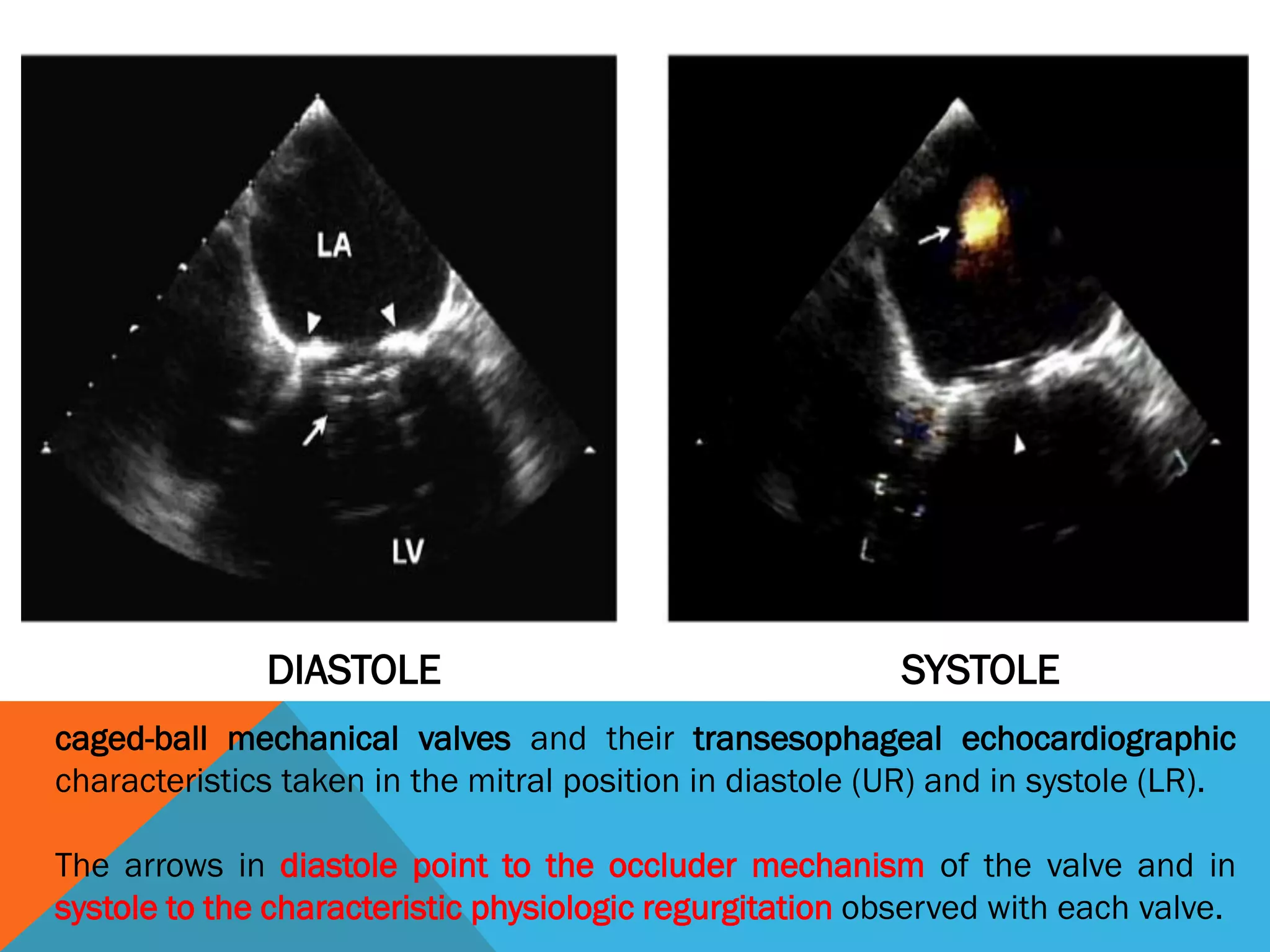 Echocardiographic recognition, function and dysfunction of prosthetic ...