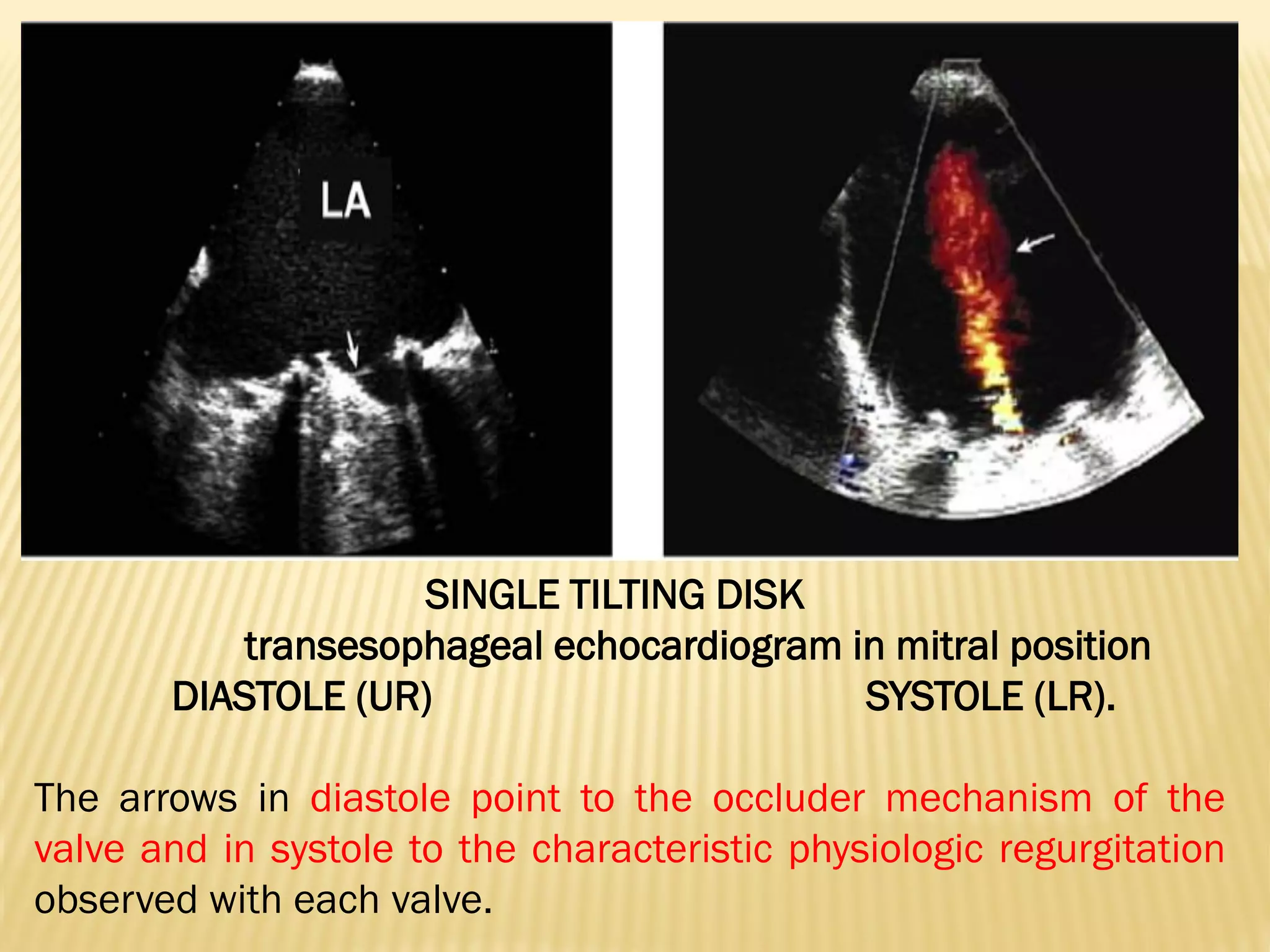 Echocardiographic recognition, function and dysfunction of prosthetic ...