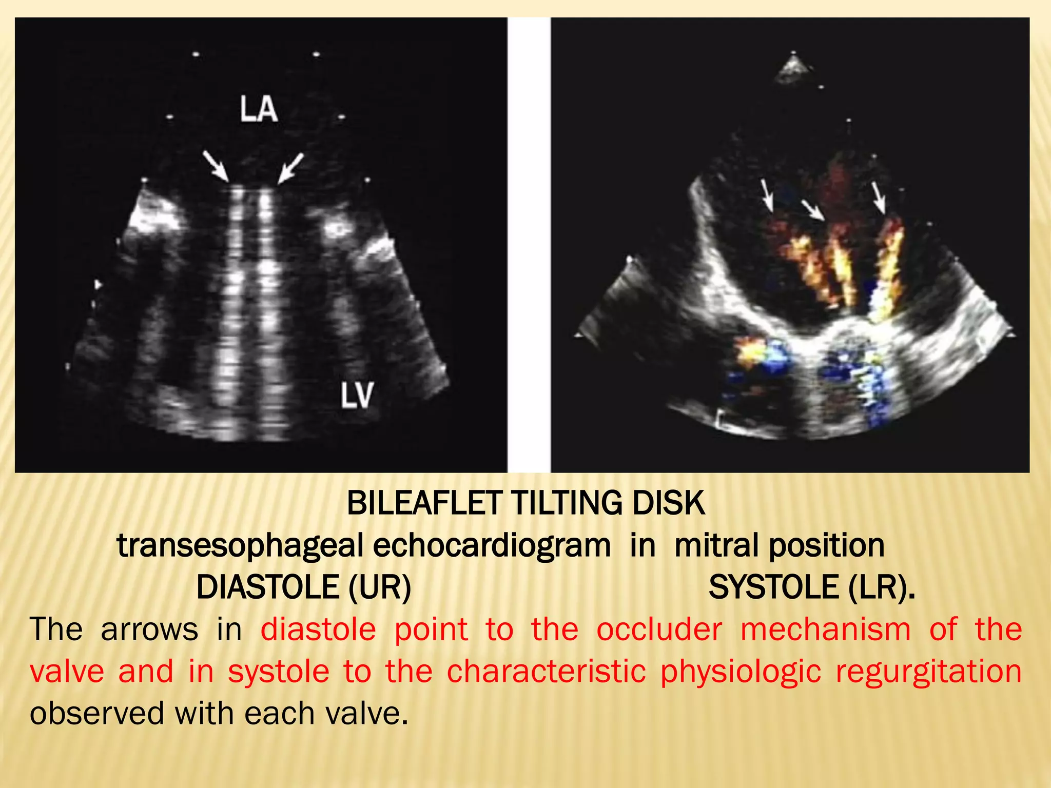 Echocardiographic recognition, function and dysfunction of prosthetic ...