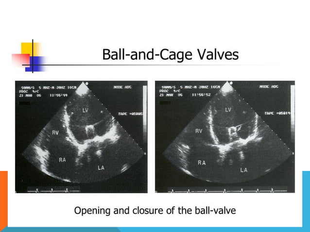 Echocardiographic recognition, function and dysfunction of prosthetic ...