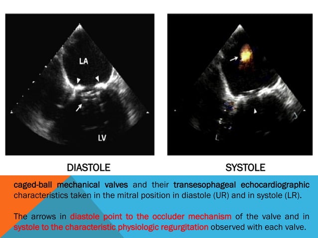 Echocardiographic recognition, function and dysfunction of prosthetic ...