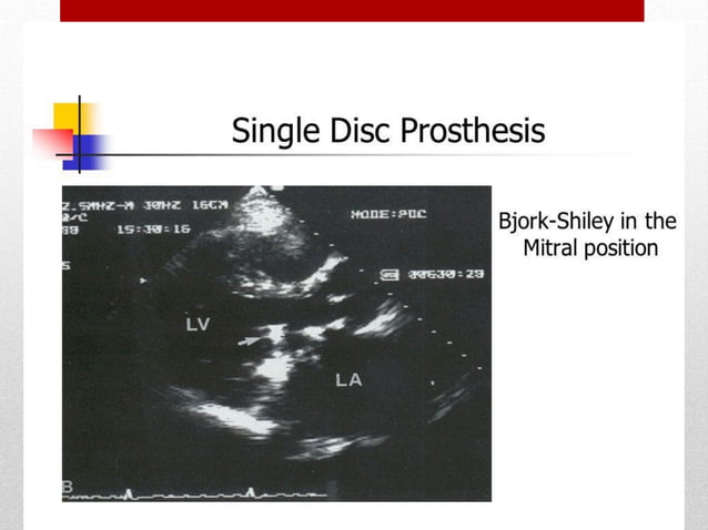 Echocardiographic recognition, function and dysfunction of prosthetic ...