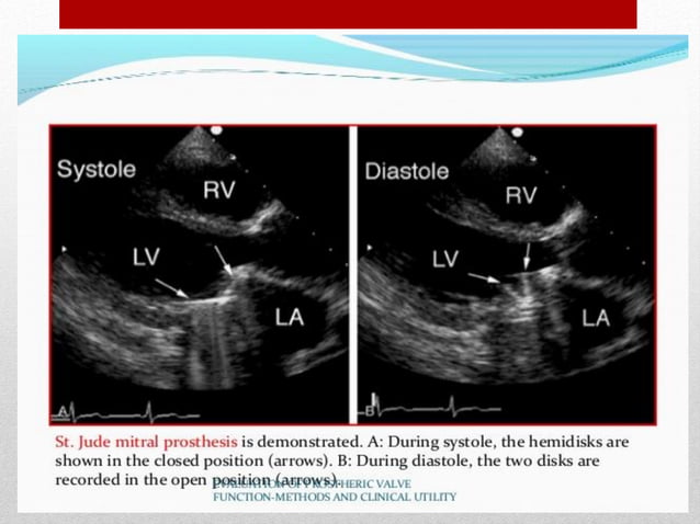 Echocardiographic recognition, function and dysfunction of prosthetic ...