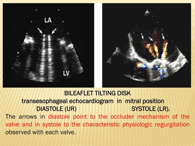 Echocardiographic recognition, function and dysfunction of prosthetic ...