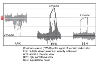 Echocardiography | PPT