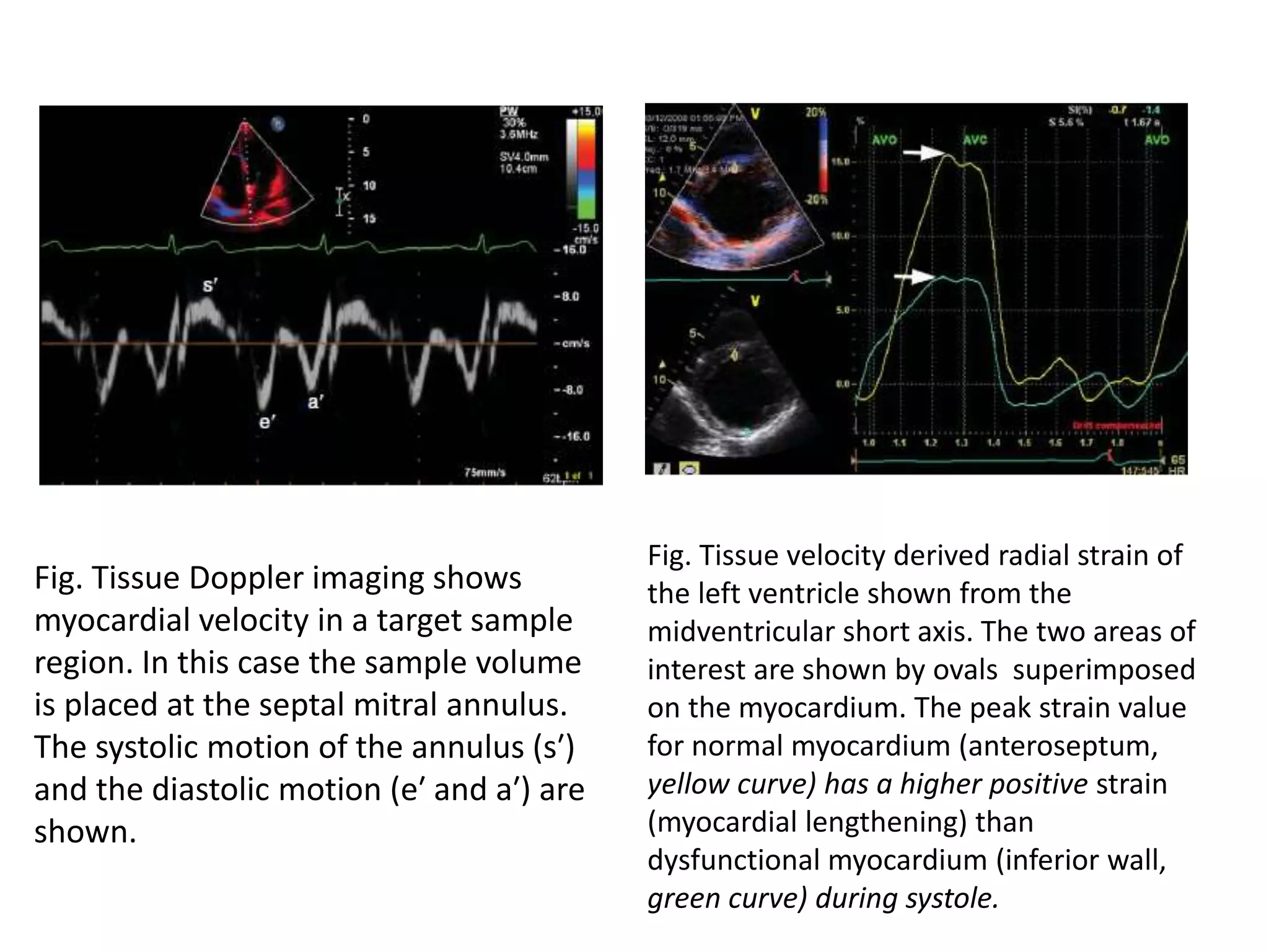 Echocardiography | PPTX