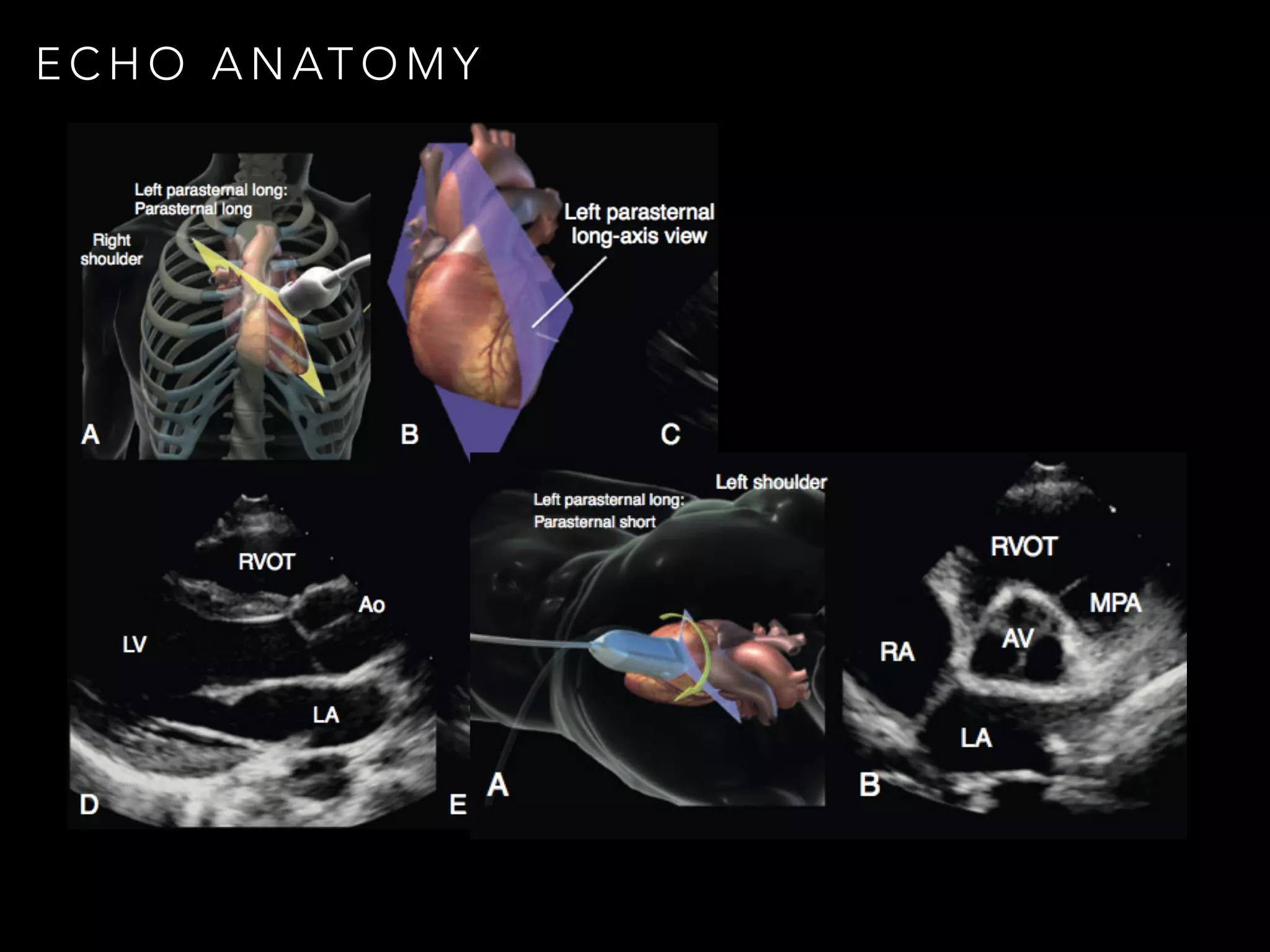 Echocardiography in aortic valve disease | PDF
