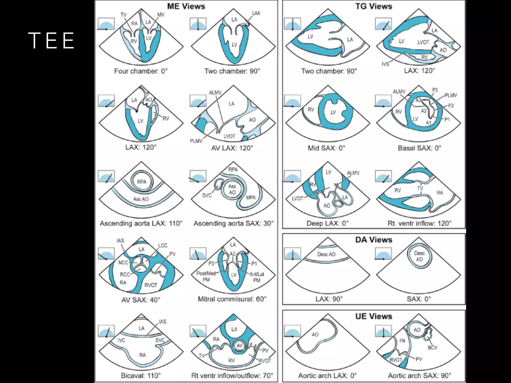 Echocardiography in aortic valve disease | PDF
