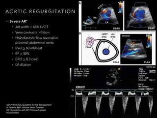 Echocardiography in aortic valve disease | PDF