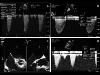 Echocardiography in aortic valve disease | PDF