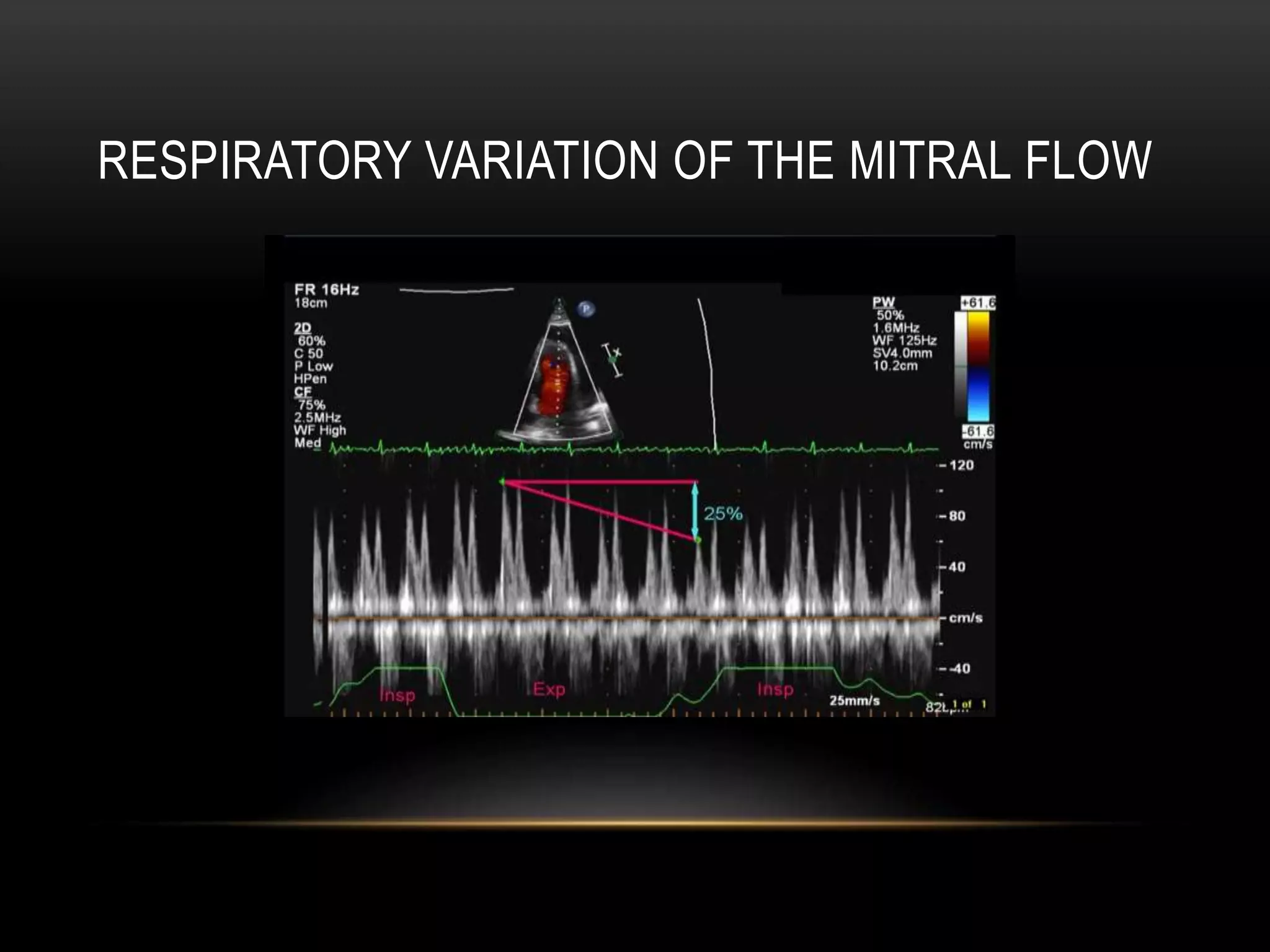Echocardiography in cardiac emergency | PPTX