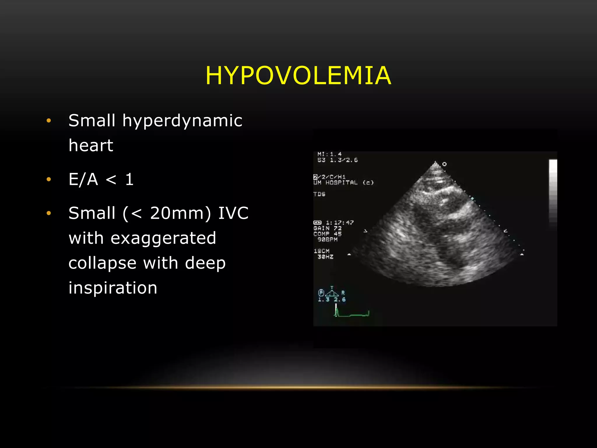 Echocardiography in cardiac emergency | PPTX