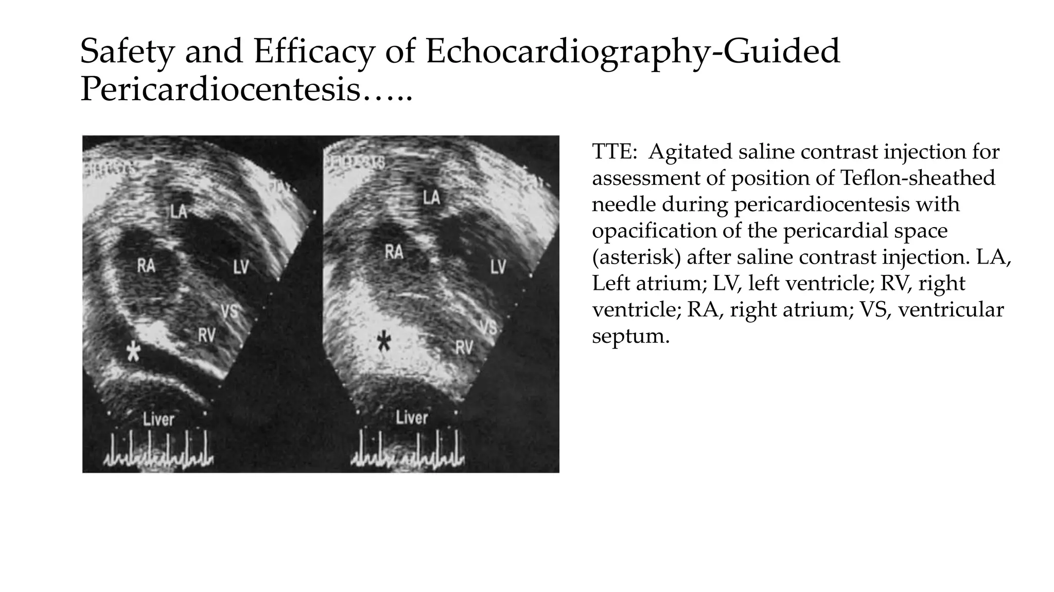 Echocardiography in intervention cardiology | PPTX | Heart and ...