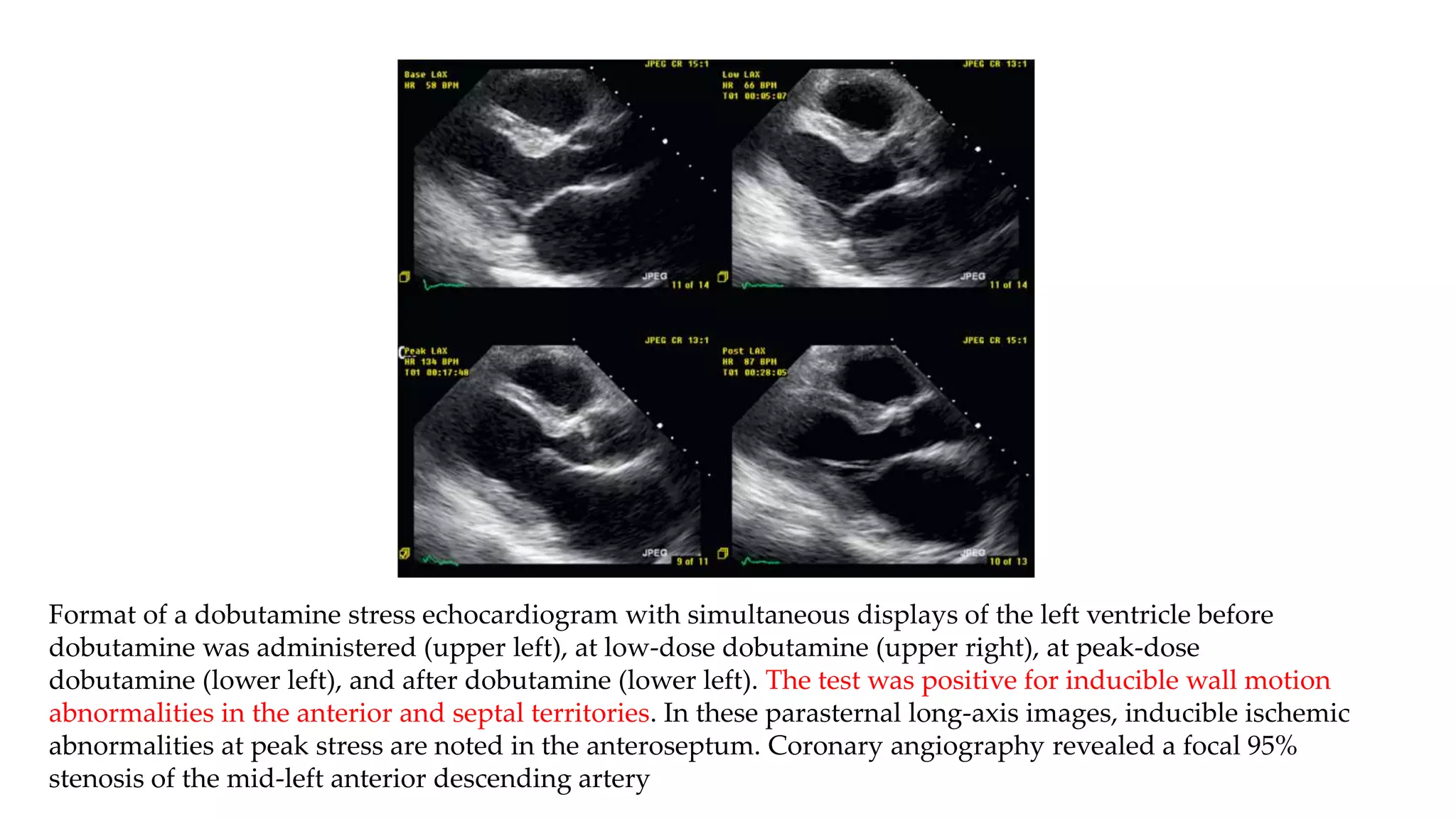 Echocardiography in intervention cardiology | PPTX | Heart and ...