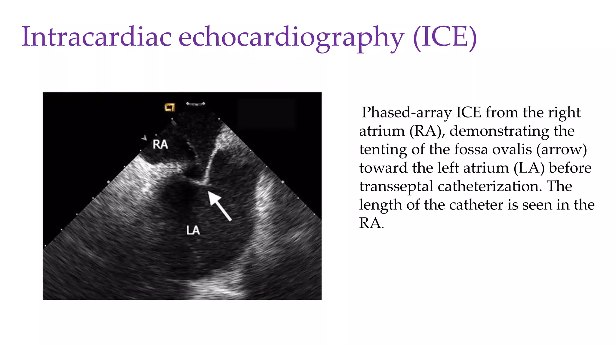Echocardiography in intervention cardiology | PPTX | Heart and ...
