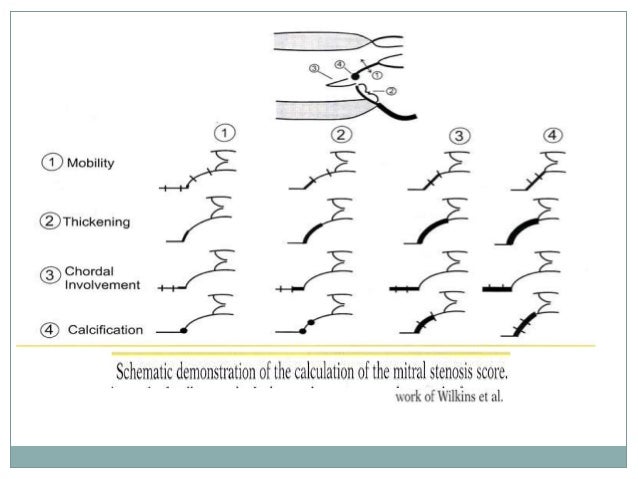 Echocardiography in mitral_stenosis