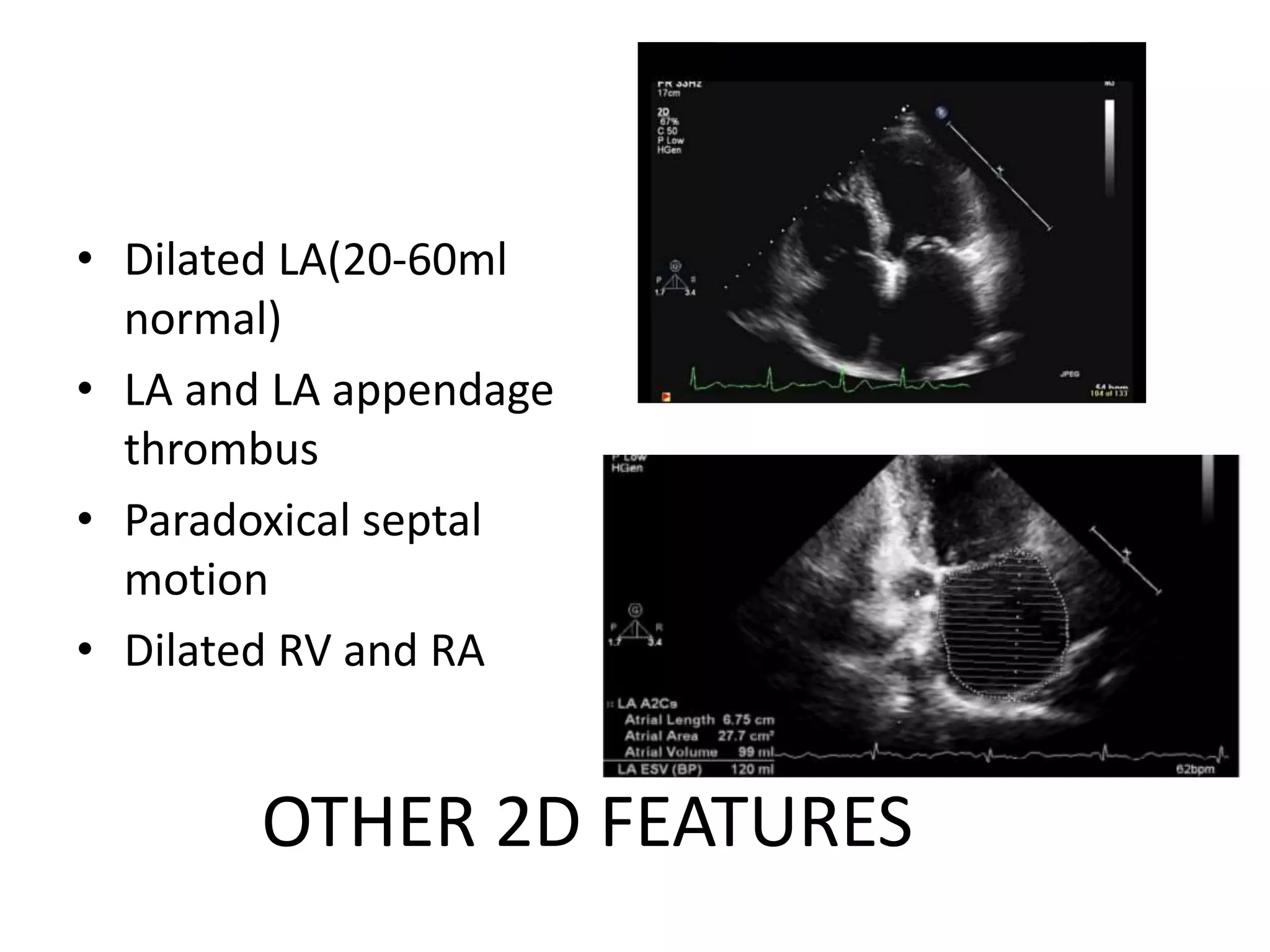 Echocardiography in mitral stenosis | PPTX