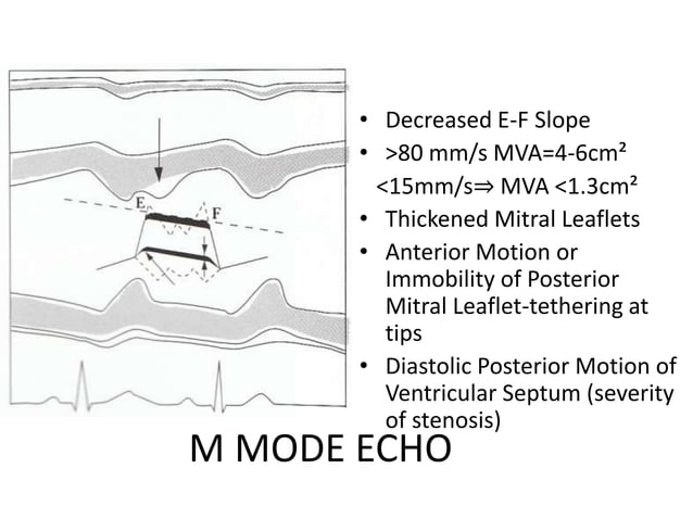 Echocardiography in mitral stenosis | PPTX