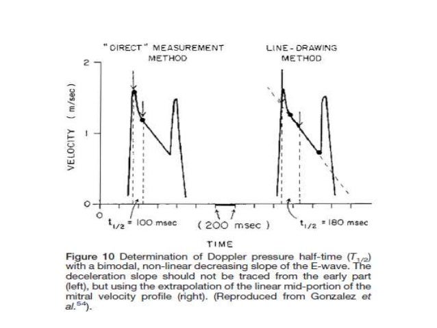 Echocardiography in mitral stenosis