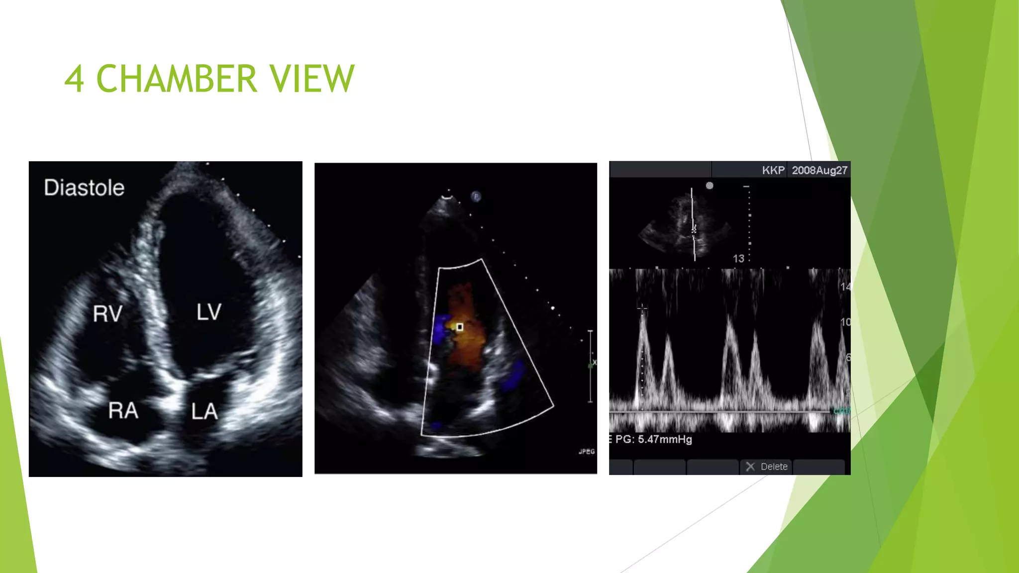 Echocardiography in res failure | PPT