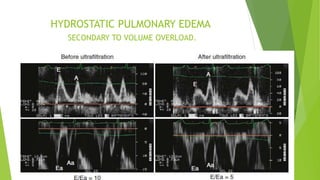 Echocardiography in res failure | PPT