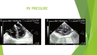 Echocardiography in res failure | PPT