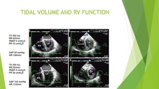 Echocardiography in res failure | PPT