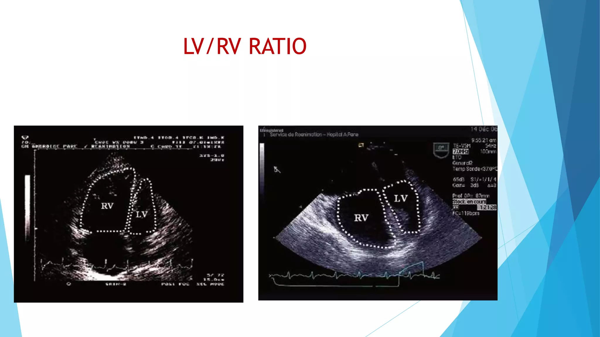 Echocardiography in shock | PPTX