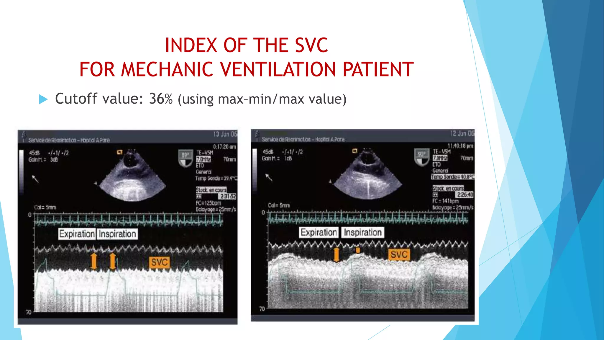 Echocardiography in shock | PPTX