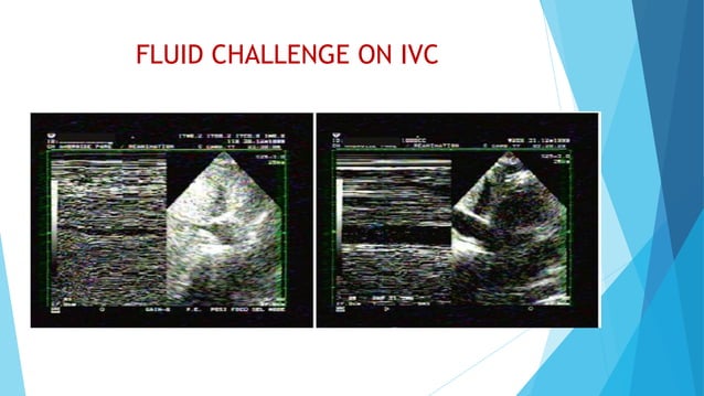 Echocardiography in shock | PPT