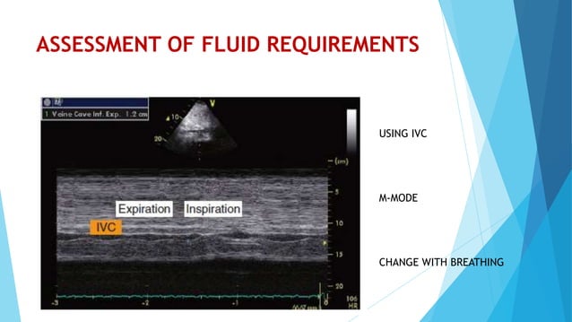 Echocardiography in shock | PPT