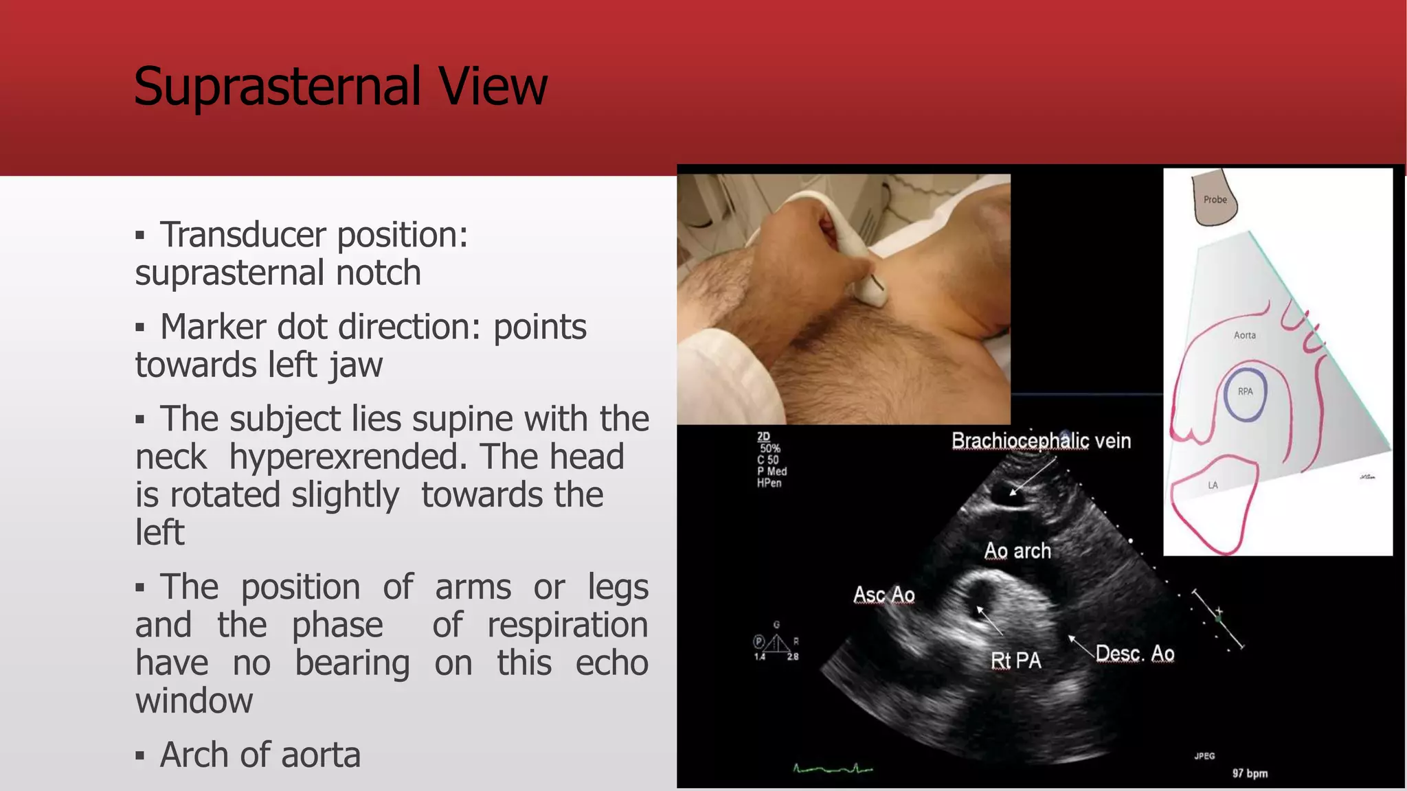 Echocardiography | PPTX