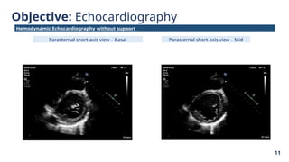 Echocardiography at CVCU of a patient.pptx