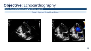 Echocardiography at CVCU of a patient.pptx