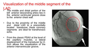echo evaluation of coronary arteries.pptx