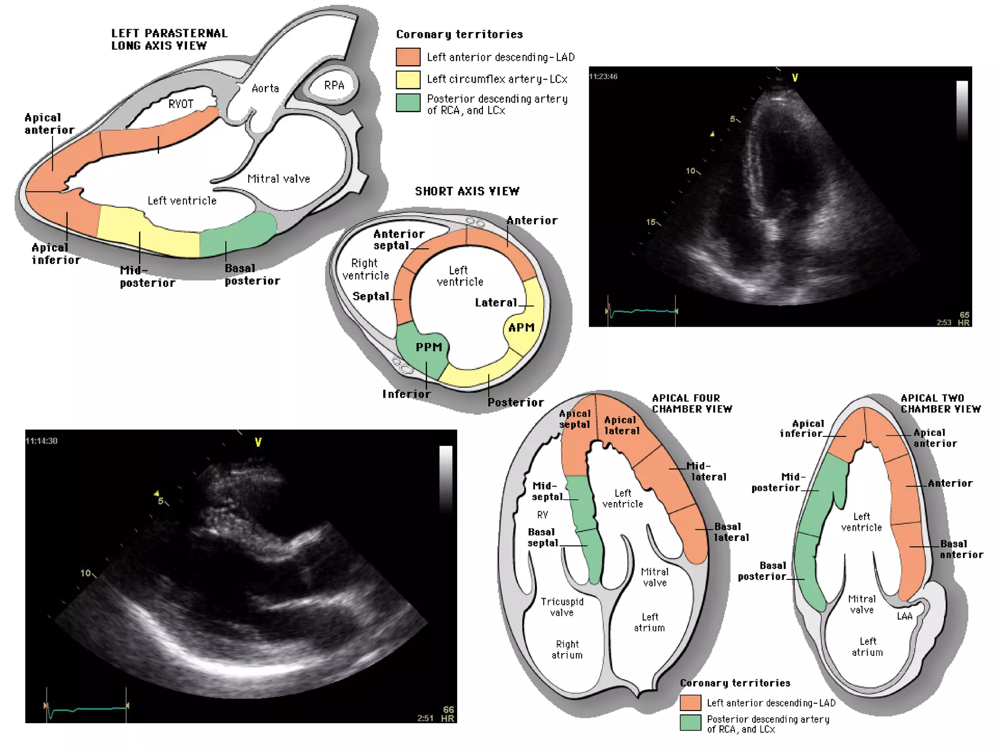 Echocardiography for Acute Coronary Syndrome | PDF