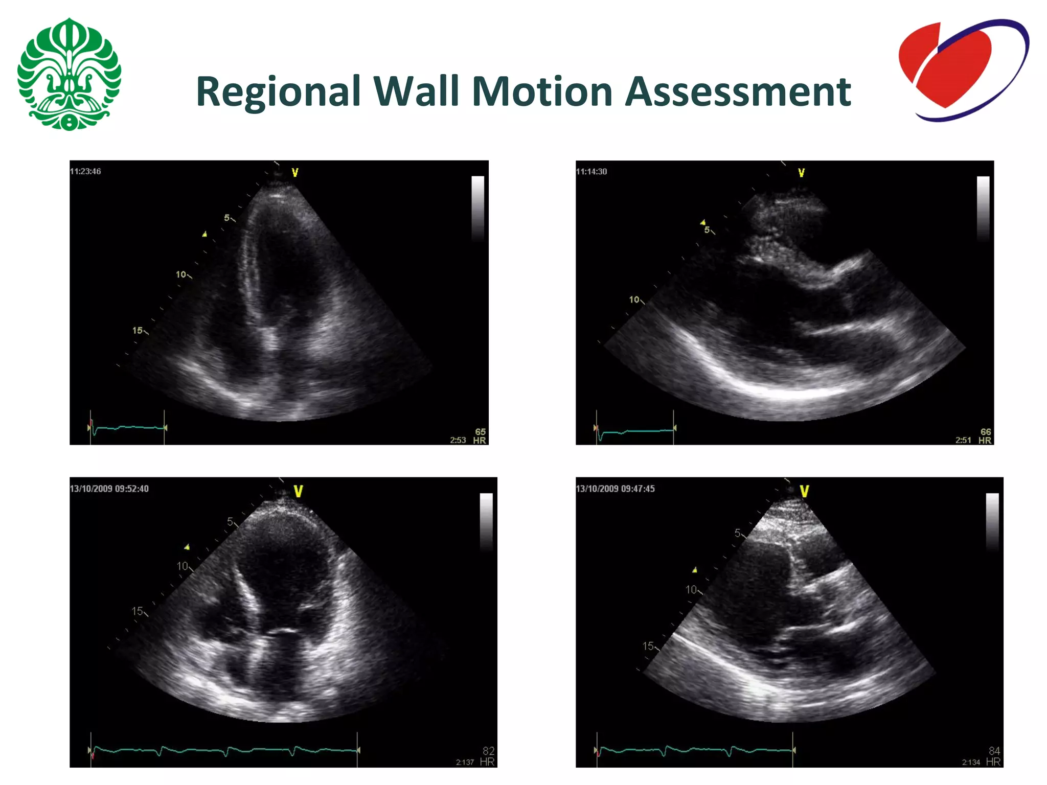 Echocardiography for Acute Coronary Syndrome | PDF
