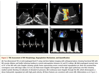 Echo for transcatheter valve therapies - Copy.pptx